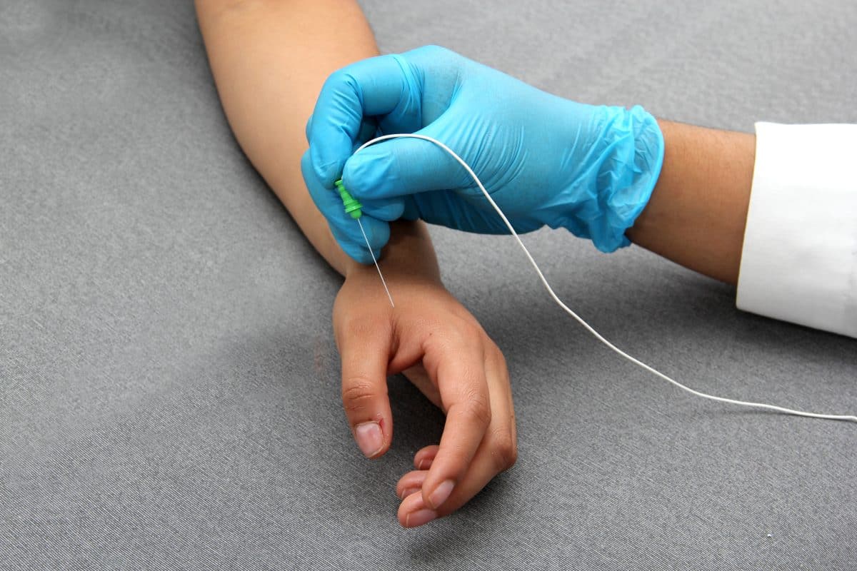 Nerve Conduction Study (NCS) - South Coast Neuroscience